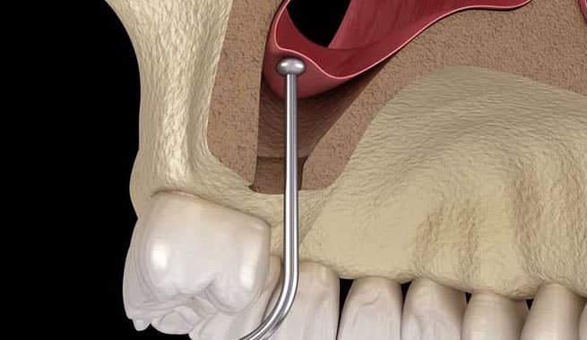 Sinus Augmentation | Littleton, CO | Red Rocks Family Dentistry