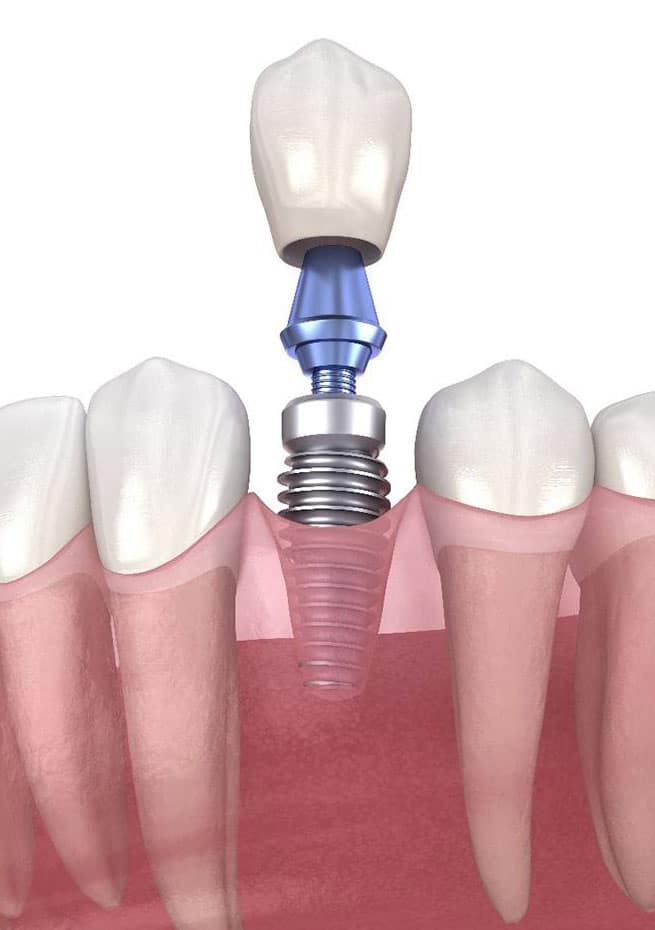 Periodontist | Littleton, CO | Red Rocks Family Dentistry