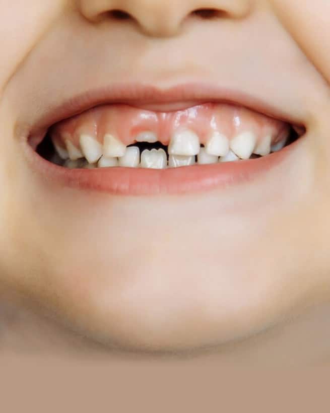 First Dental Visit for Kids | Littleton, CO | Red Rocks Family Dentistry